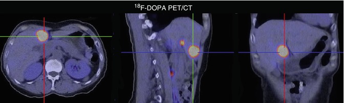 Imaging of Tumor Metabolism: PET with Other Metabolites | Radiology Key