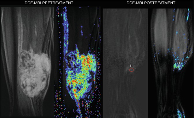 Perfusion Imaging by Magnetic Resonance | Radiology Key