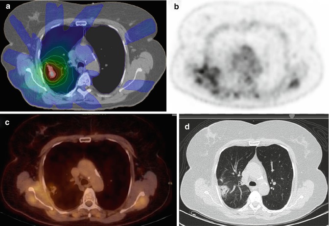 Radiotherapy and Imaging | Radiology Key