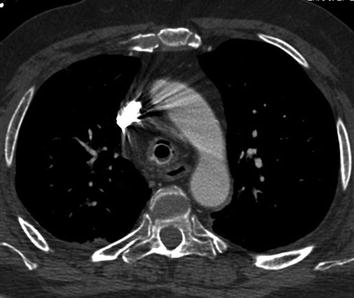 Tracheobronchial Foreign Bodies | Radiology Key