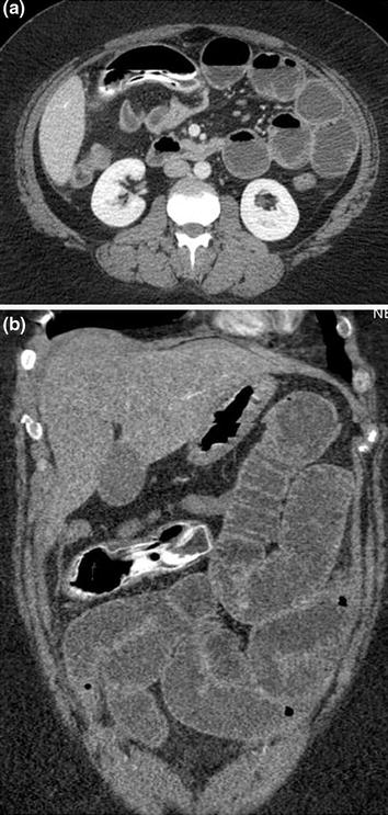 Foreign Bodies of the Gastrointestinal Tract | Radiology Key