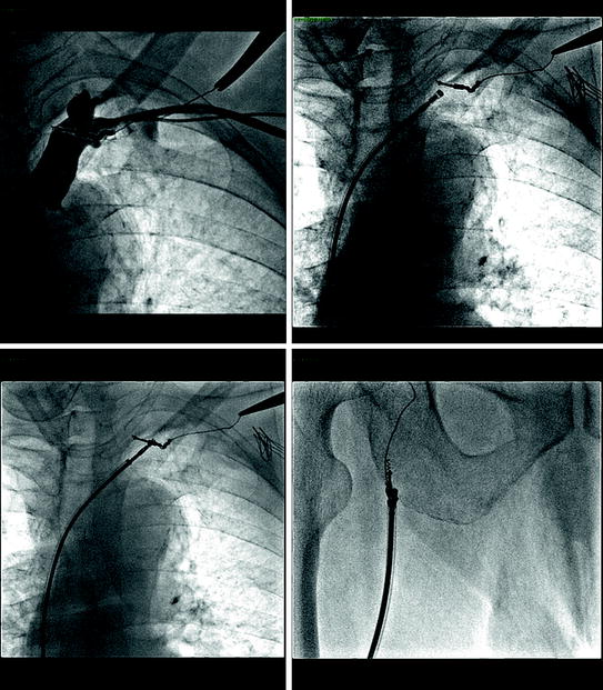 Intravascular Foreign Bodies | Radiology Key