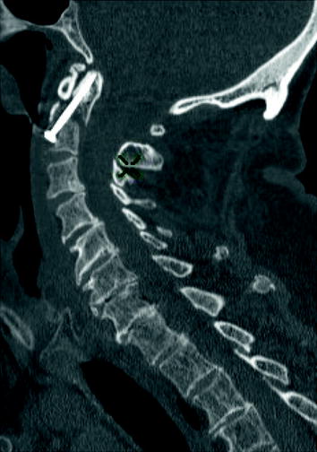 Retained Intracranial and Intraspinal Foreign Bodies | Radiology Key