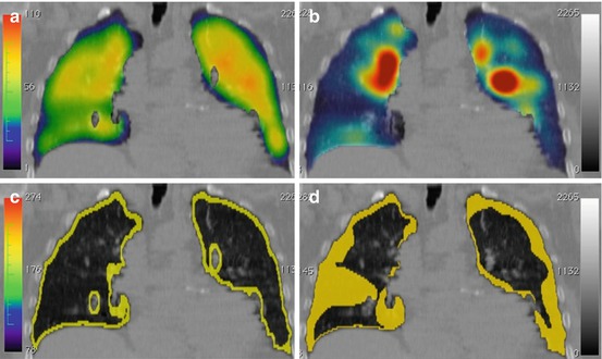 Lung SPECT/CT | Radiology Key