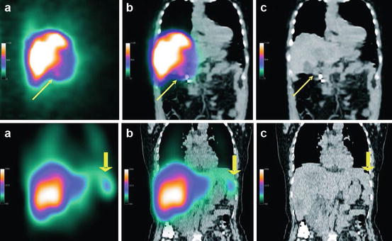 Lung SPECT/CT | Radiology Key