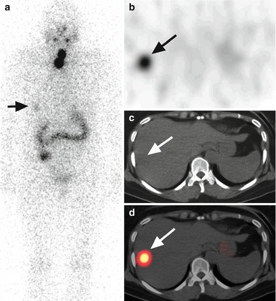 Lung SPECT/CT | Radiology Key