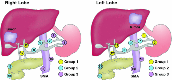 Management of Intra-Hepatic Cholangiocarcinoma | Radiology Key