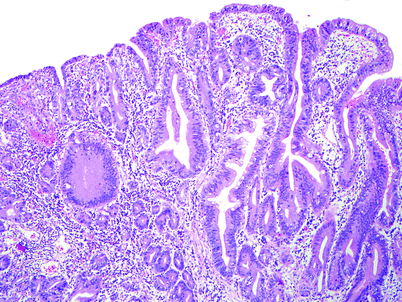 of Gallbladder Cancer | Radiology Key