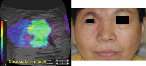 Cancer of the Head and Neck | Radiology Key