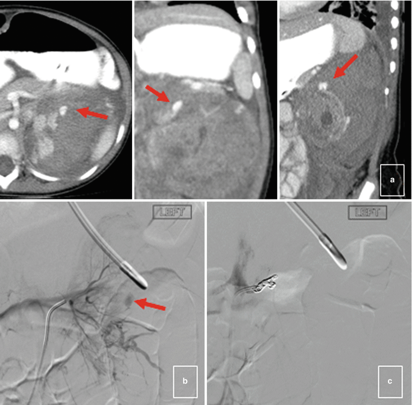 Renal Angiography and Embolization | Radiology Key