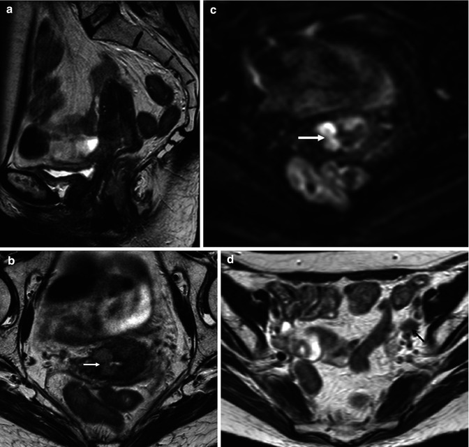 Functional MRI of Uterine (Endometrial and Cervical) Cancer | Radiology Key