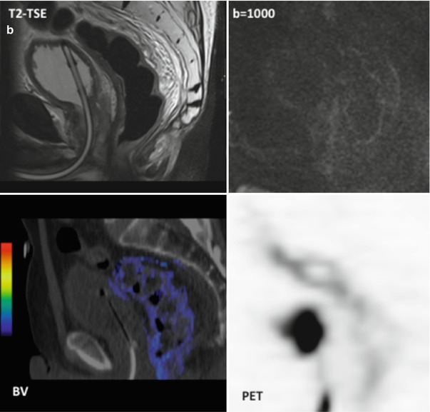 Imaging of Tumor Metabolism: MR Spectroscopy | Radiology Key
