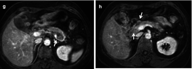 Pancreatic Adenocarcinoma and Other Pancreatic Malignancies | Radiology Key