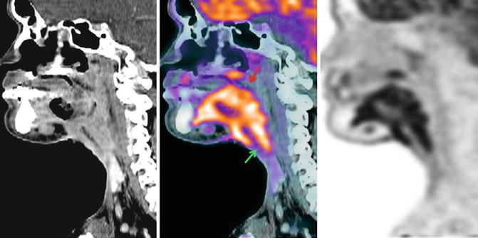 Head and Neck Cancer | Radiology Key