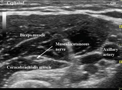 Brachial Plexus Block | Radiology Key