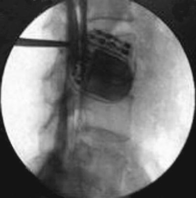 The Racz Procedure: Lysis of Epidural Adhesions (Percutaneous ...