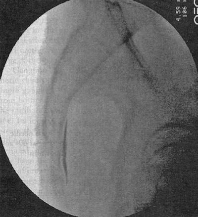 Neurolytic Agents | Radiology Key