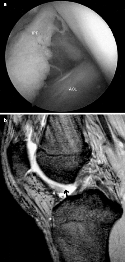 Disorders of Synovium and Plica | Radiology Key