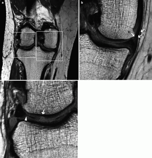 Posterior Cruciate Ligament (PCL) | Radiology Key