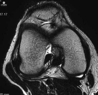 Anterior Cruciate Ligament (ACL) | Radiology Key