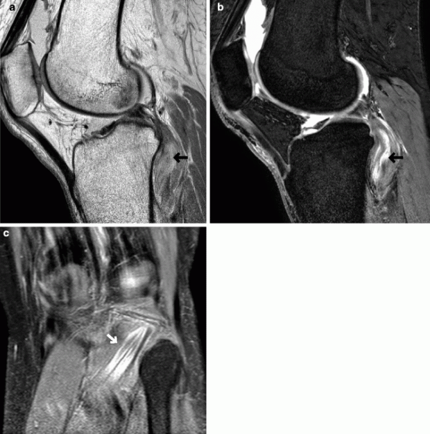 Posterior Cruciate Ligament (PCL) | Radiology Key
