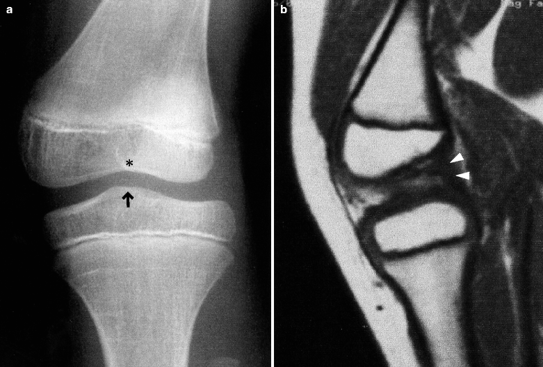 Pediatric and Adolescent Disorders of the Knee | Radiology Key
