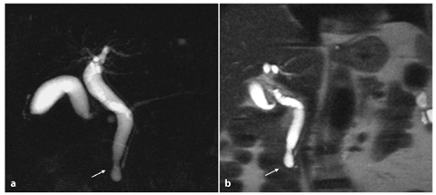 Normal Anatomy of the Biliary Tree, Gallbladder and Pancreatic Duct ...