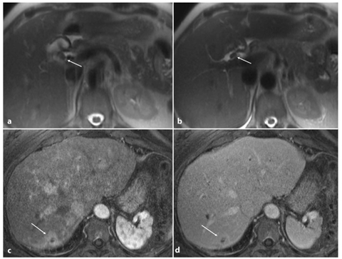 Magnetic Resonance Cholangiopancreatography in Biliary Lithiasis ...
