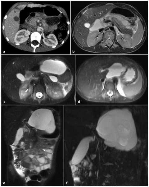 Acute Pancreatitis | Radiology Key