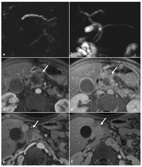 Chronic Pancreatitis | Radiology Key