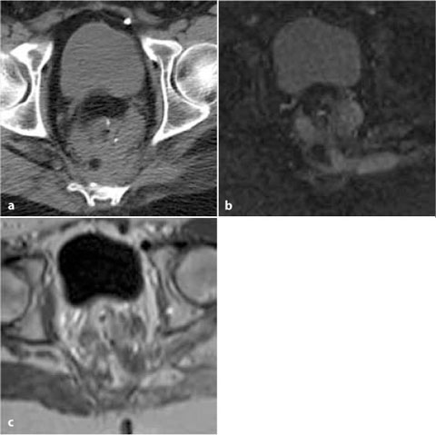 Ulcerative Colitis and Ileal Pouch Surgery | Radiology Key