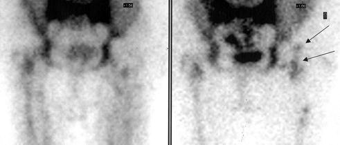 Role of Nuclear Medicine in Prosthesis Surveillance | Radiology Key