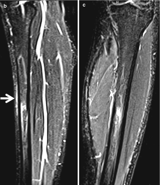 Types of Fractures in Children | Radiology Key