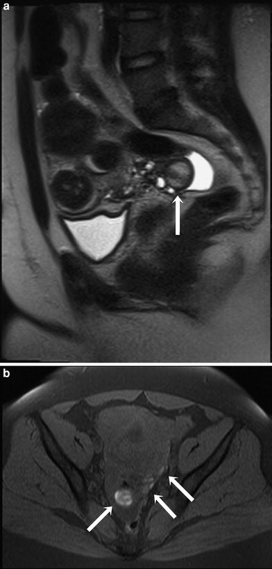 Artery Embolization Indications and Contraindications | Radiology Key