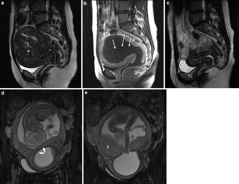 Fibroids Pre and Post Uterine Artery Embolisation | Radiology Key