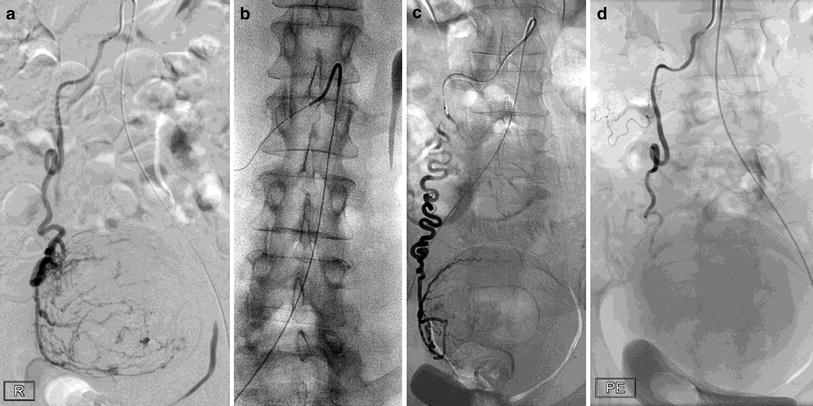to Consider Ovarian Artery Embolization in UAE | Radiology Key