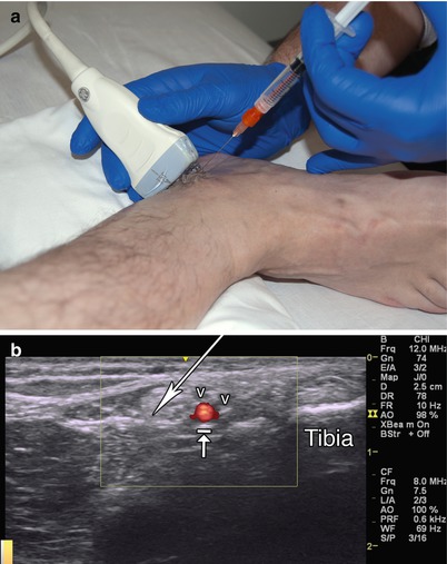 Trigger Point Injections | Radiology Key