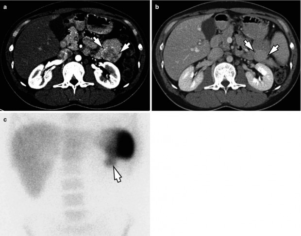 Pancreatitis | Radiology Key