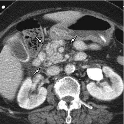 Trauma and Post-treatment Complications of the Pancreas | Radiology Key