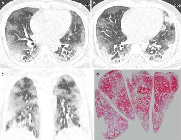 Consolidation | Radiology Key
