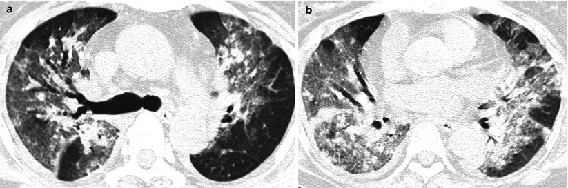 Pneumonia | Radiology Key