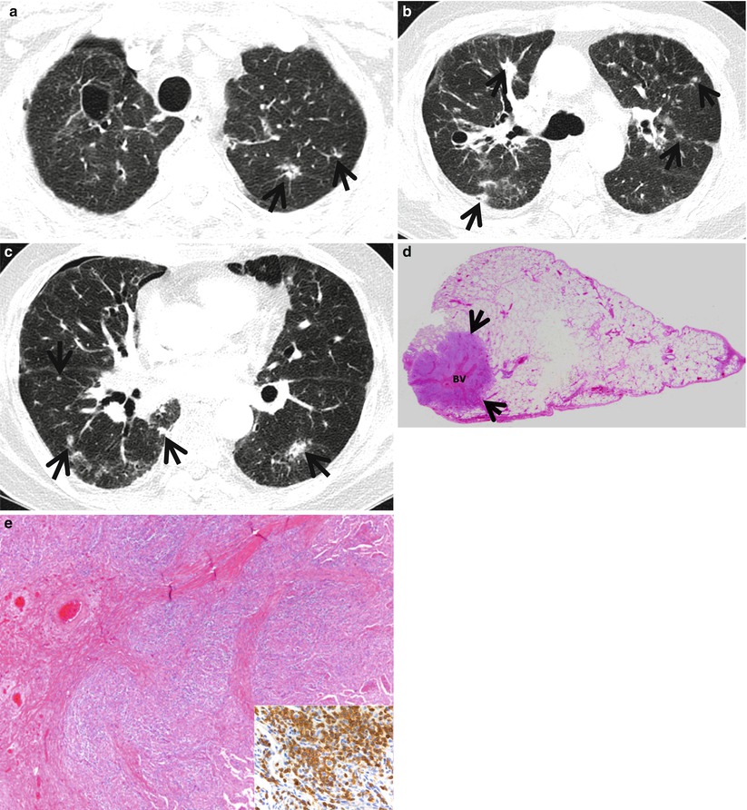Consolidation | Radiology Key