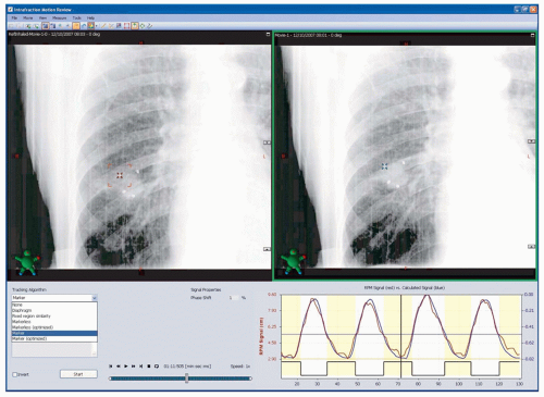 Platforms for Image-guided and Adaptive Radiation Therapy | Radiology Key