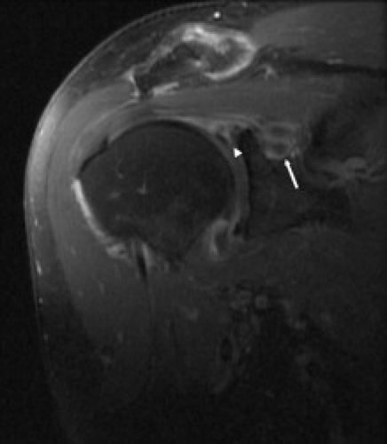 MRI of Finger Tendons | Radiology Key