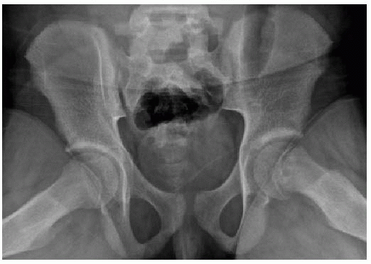 Hip Disorders | Radiology Key