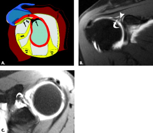 Long Bicipital Tendon Including Superior Labral Anterior–Posterior ...