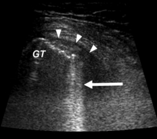 What Is The Cpt Code For Shoulder Bursectomy