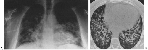 Chest Infections | Radiology Key