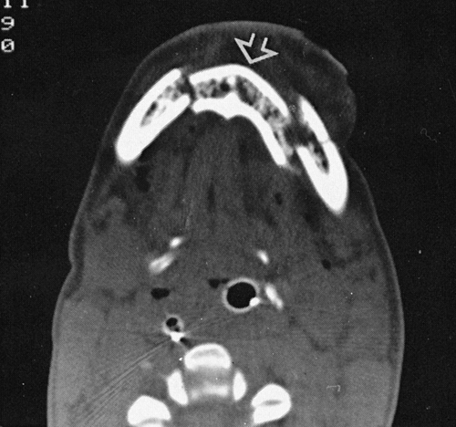 Facial Trauma | Radiology Key