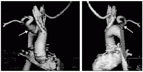 Thoracic Magnetic Resonance Angiography | Radiology Key
